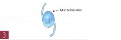 Multifokallinsen: Trifokallinsen beim Testsieger EuroEyes