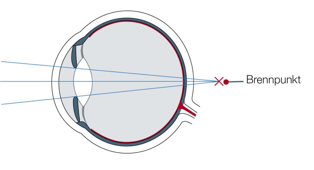 Weitsichtigkeit lasern und behandeln lassen mit EuroEyes