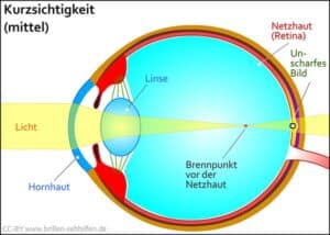Was bedeutet Dioptrien? | Bedeutung, Ermittlung & Behandlung